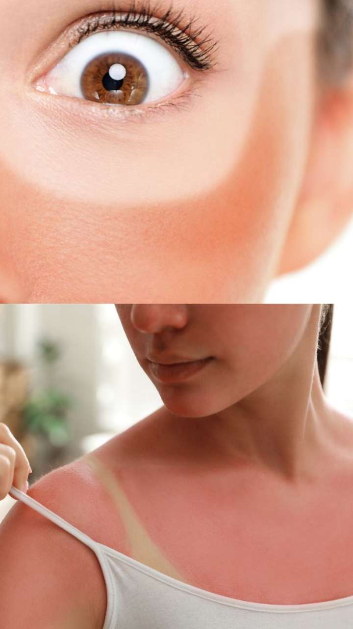 Tanning Vs Sunburn: Check 6 Major Differences!