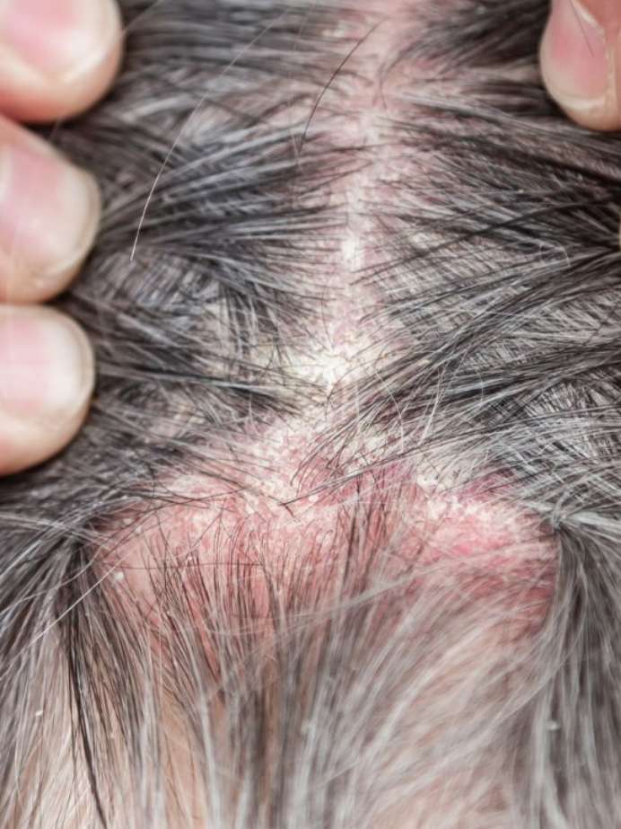 What Is Scalp Psoriasis? Check Its Signs