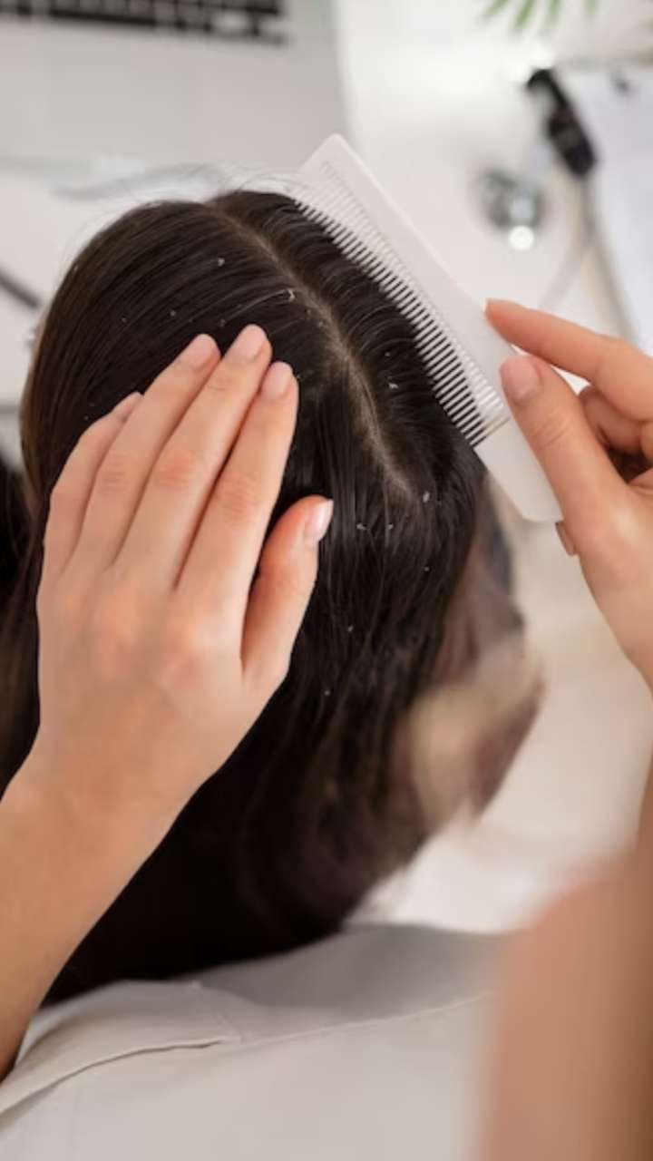 Top 5 Tips To Deal With Dandruff During Winter