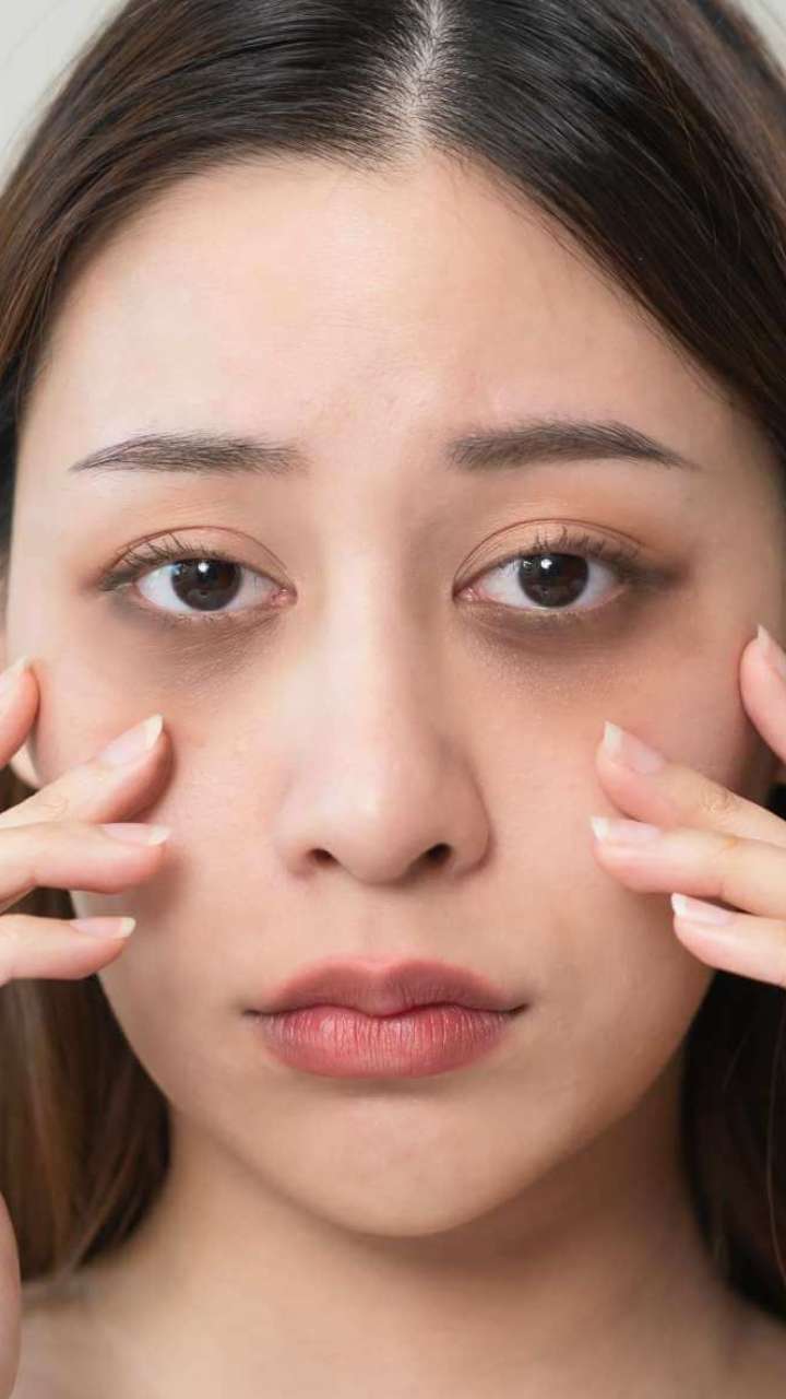 7 Home Remedies To Remove Dark Circles