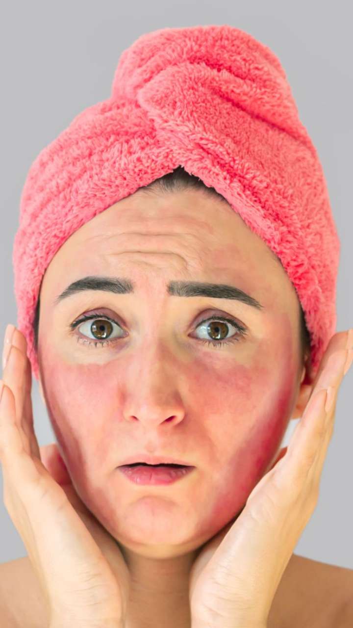 5 Effective Home Remedies To Treat Sunburn 5 Effective Home Remedies To Treat Sunburn