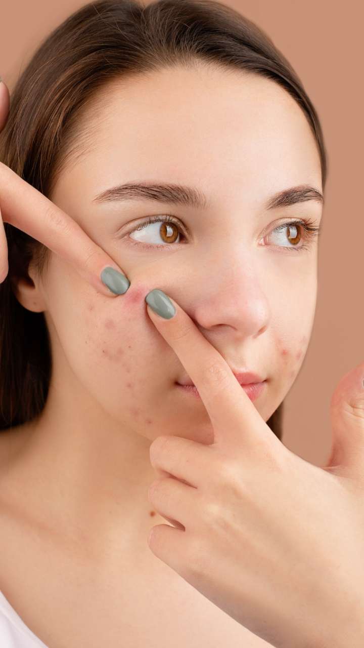 DIY- Tomato mask with home ingredients to prevent monsoon acne